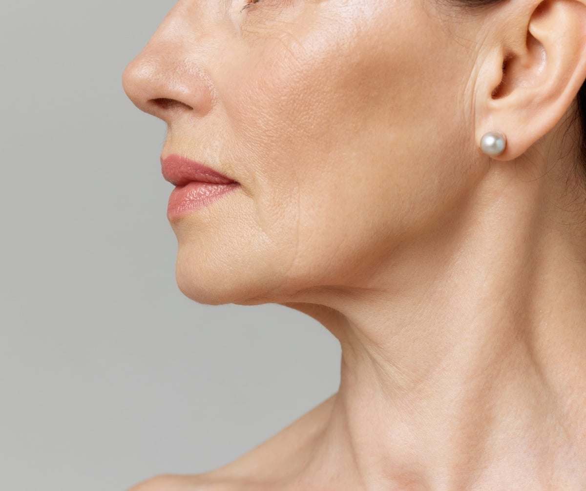 Kybella® Treatment in Bozeman, MT - Dr. Aaron Bruce, FAAD - SkinCare MT